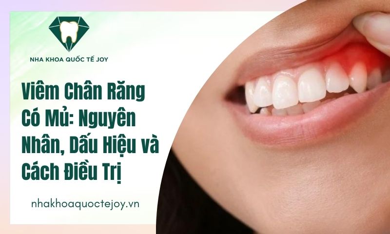 Viêm chân răng có mủ: Nguyên nhân, dấu hiệu và cách điều trị - Nha khoa ...